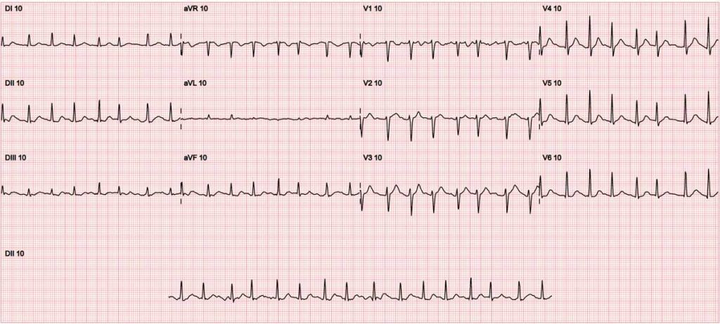 Fibrilacao Atrial Rvr Ecg Fibrilação Atrial (AFib) Com Resposta