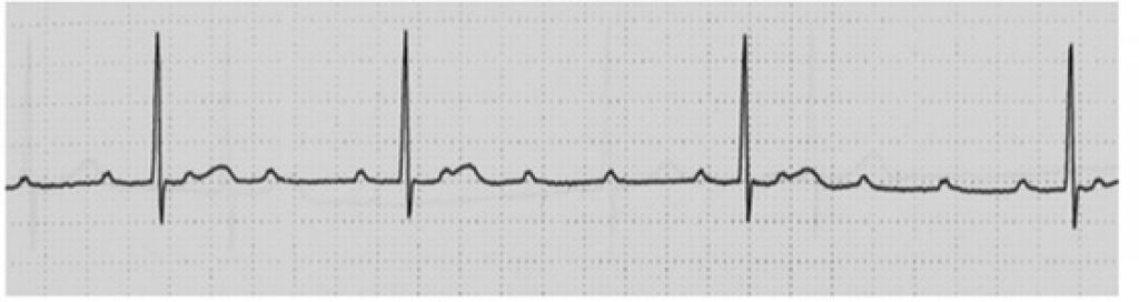 Bloqueio atrioventricular avançado - ECGNOW Bloqueio atrioventricular avançado - ECGNOW